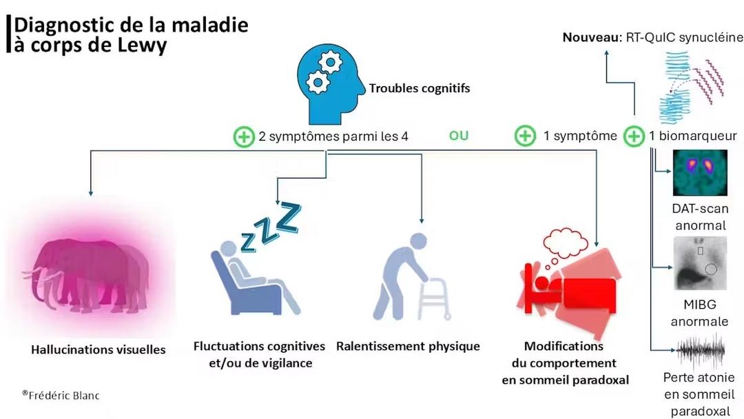 Maladie à corps de Lewy : quelle est cette maladie neurocognitive ...