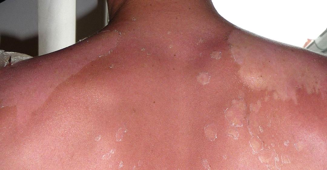Les dangers du bronzage et du soleil