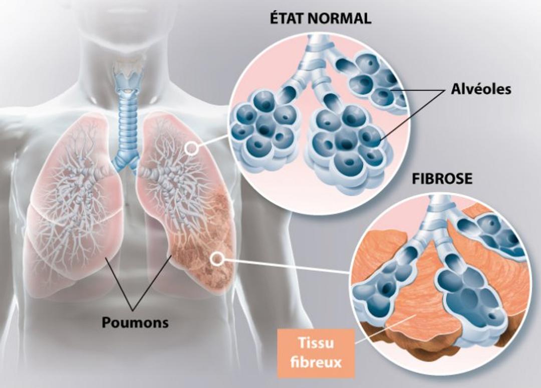 Définition | Fibrose : qu'est-ce que c'est ? | Futura santé