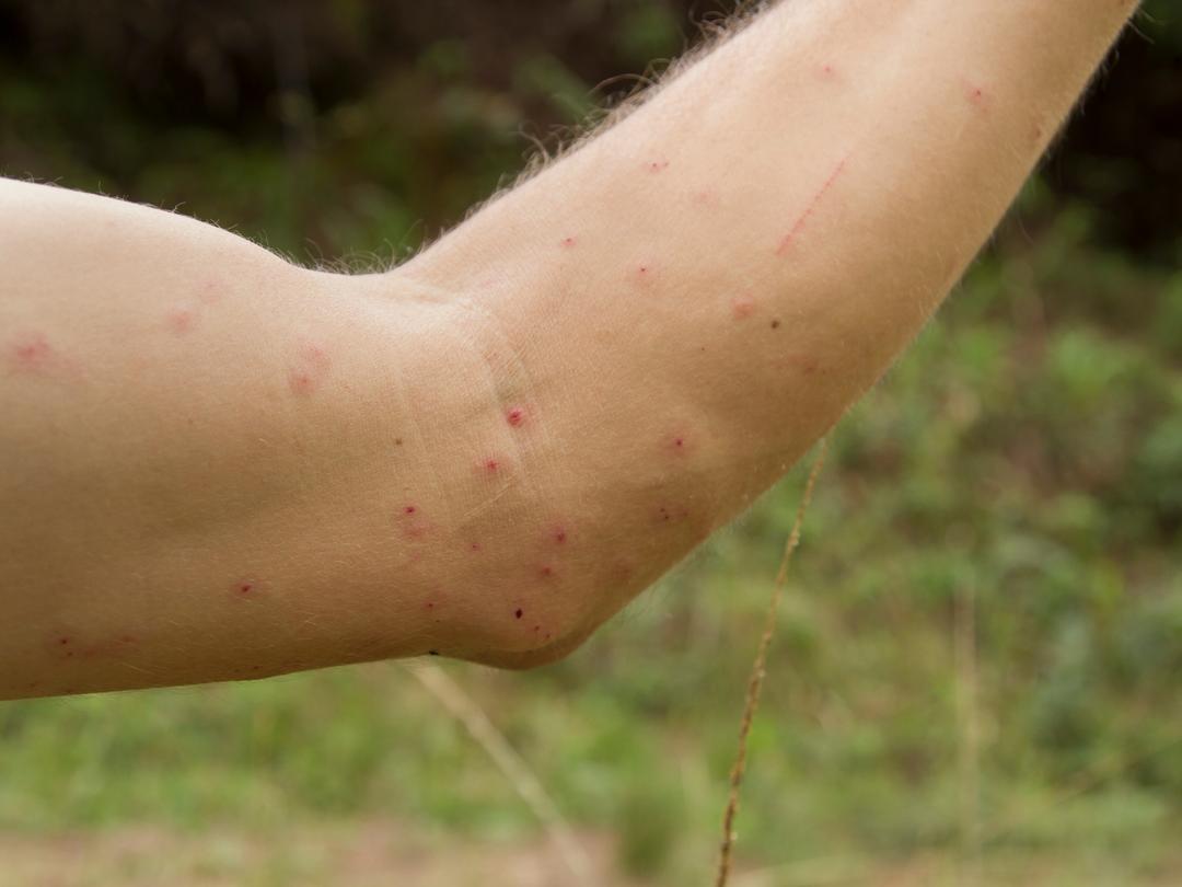 Voici comment reconnaître facilement chaque piqûre d'insectes et leurs ...