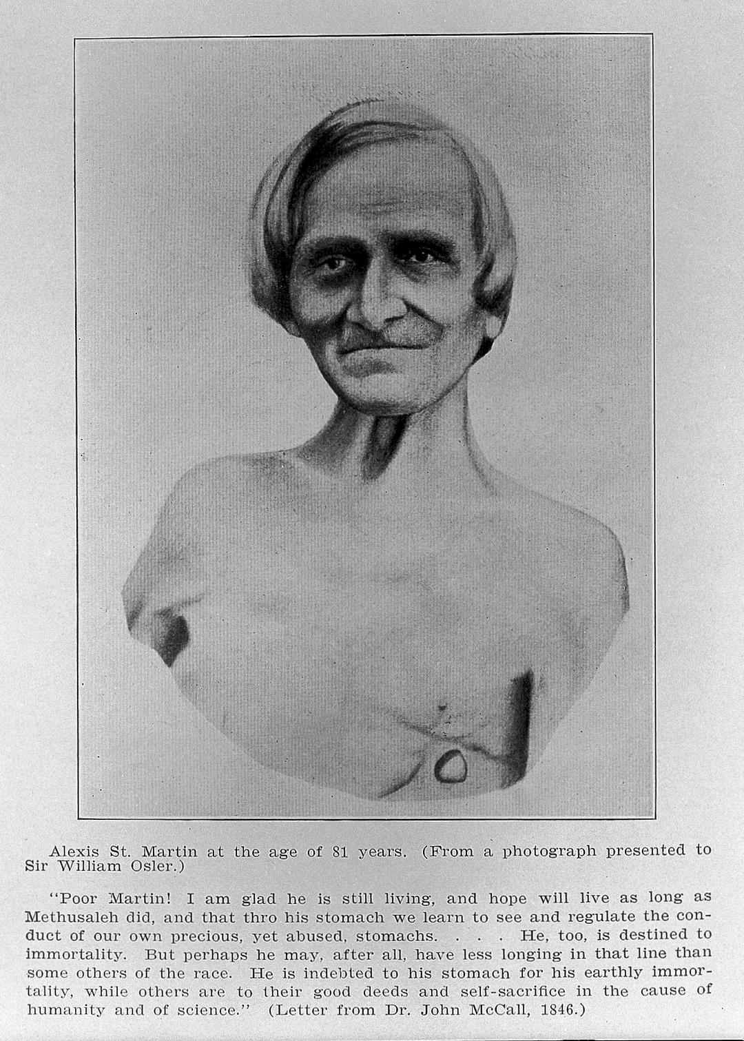 Comment William Beaumont est-il devenu le père de la physiologie ...