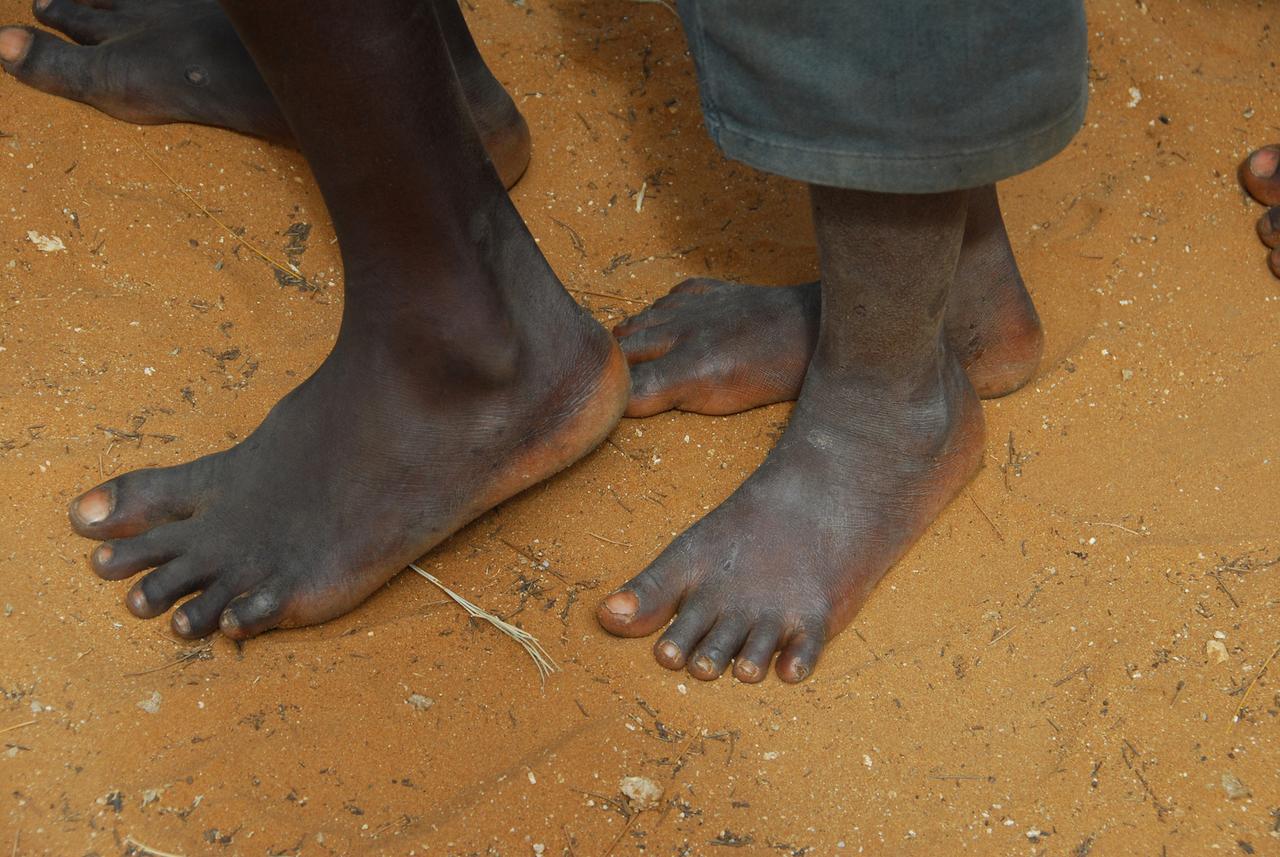 Marcher pieds nus est bon pour vos pieds