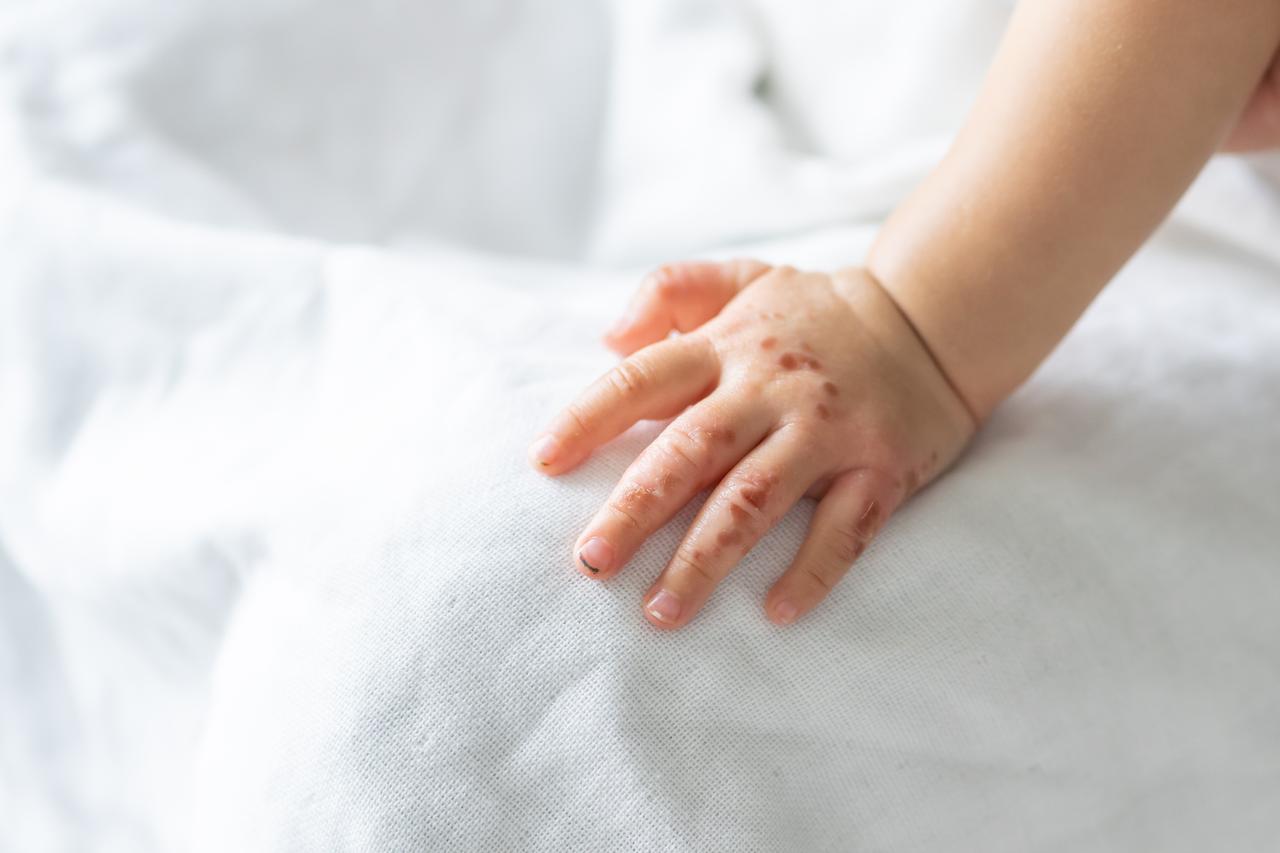 Définition | Épidermolyse bulleuse : qu'est-ce que c'est ? | Futura santé