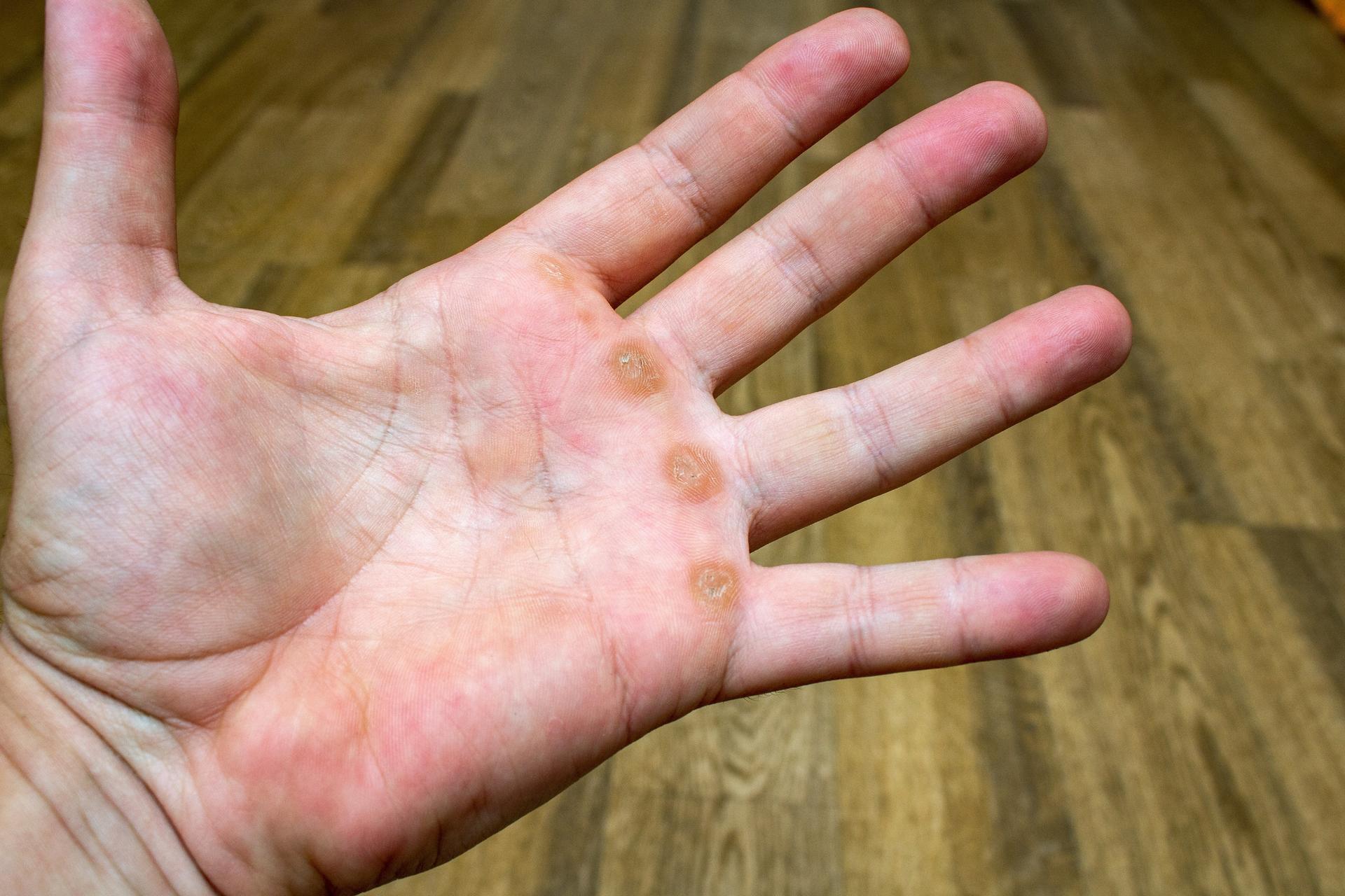 Définition | Induration : qu'est-ce que c'est ? | Futura santé