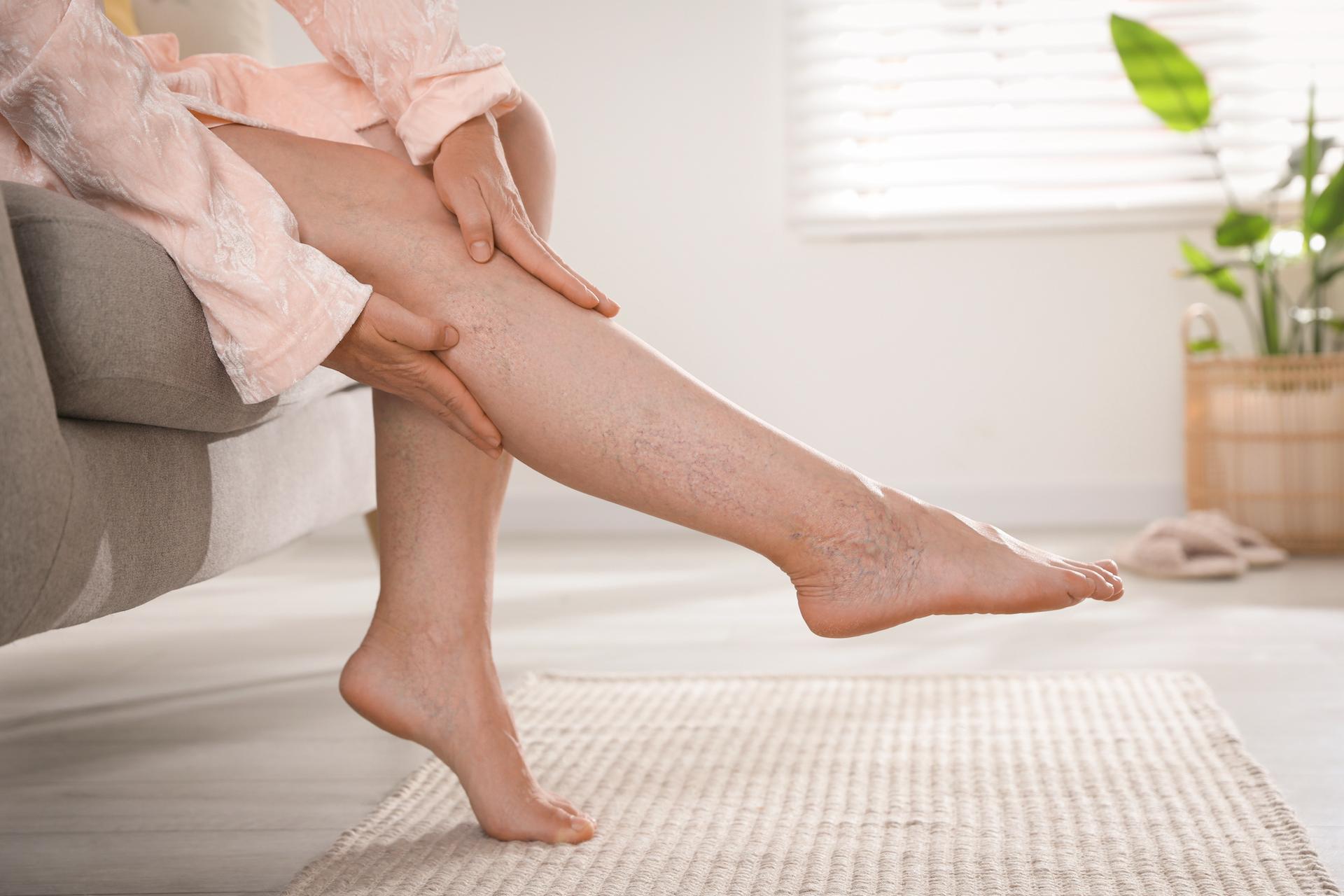 Varices et insuffisance veineuse : les comprendre et les prévenir