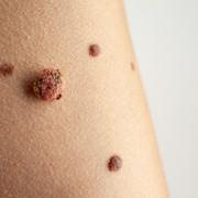 Comment reconnaitre les premiers signes d'un cancer de la peau