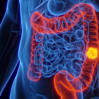 Cancer colorectal : ce test simple de 5 minutes peut détecter la ...