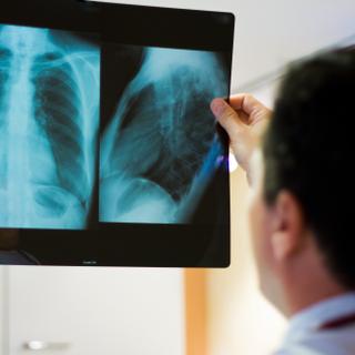 Définition | Pneumocystose : qu'est-ce que c'est ? | Futura santé