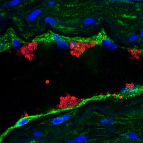 Des tests de diagnostic rapide pour la méningite à méningocoques