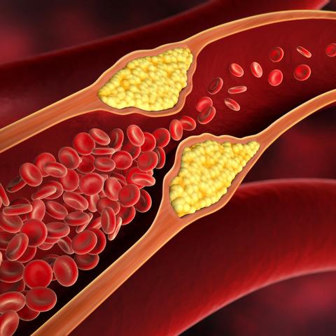 Définition | Hypervolémie : qu'est-ce que c'est ? | Futura santé
