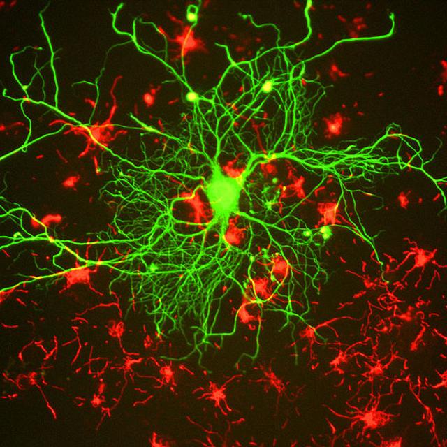 Cancer du sein : les cellules tumorales transformées en graisse