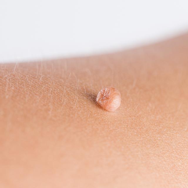 Acrochordon : quel traitement naturel pour s'en débarrasser