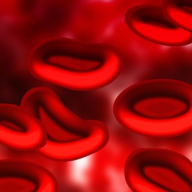 Définition | Drépanocytose : qu'est-ce que c'est ? | Futura santé