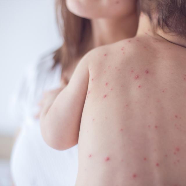 Définition | Virus de la rougeole : qu'est-ce que c'est ? | Futura santé