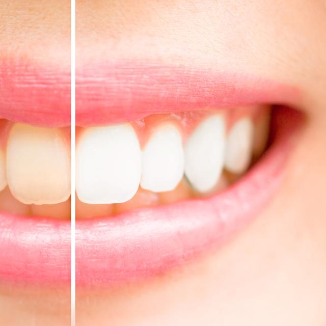Vos dents pourraient bientôt se réparer toutes seules grâce à ce gel ...