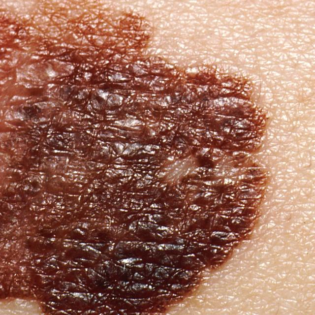 Dépistage du cancer de la peau : cette machine peut sauver des vies