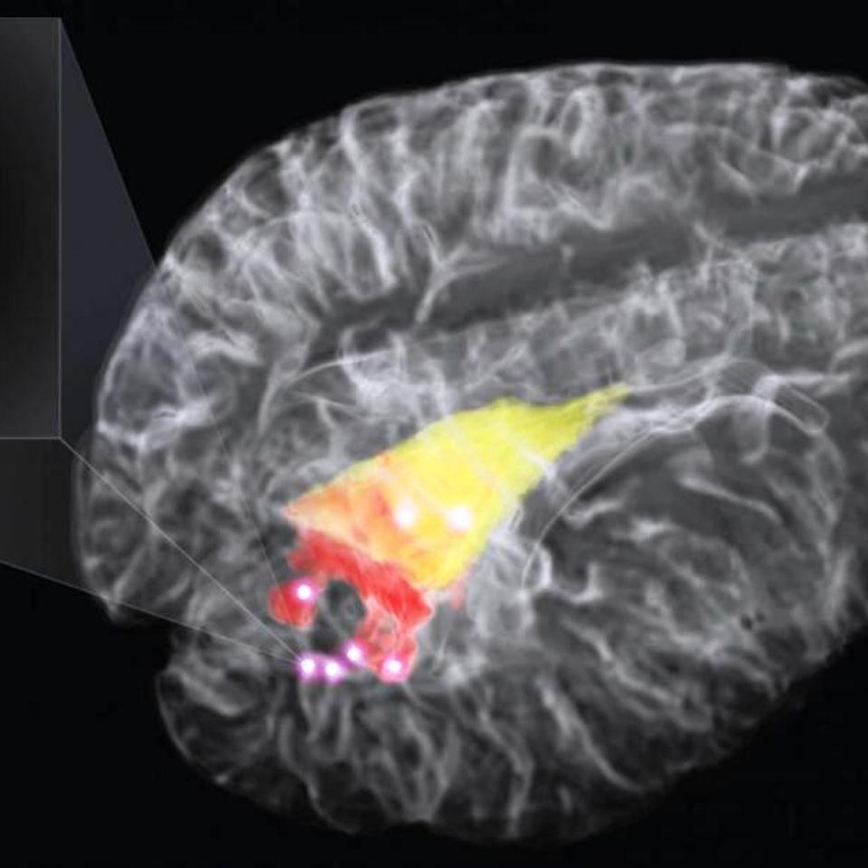 L'effet Raman, un nouvel outil contre le cancer du cerveau