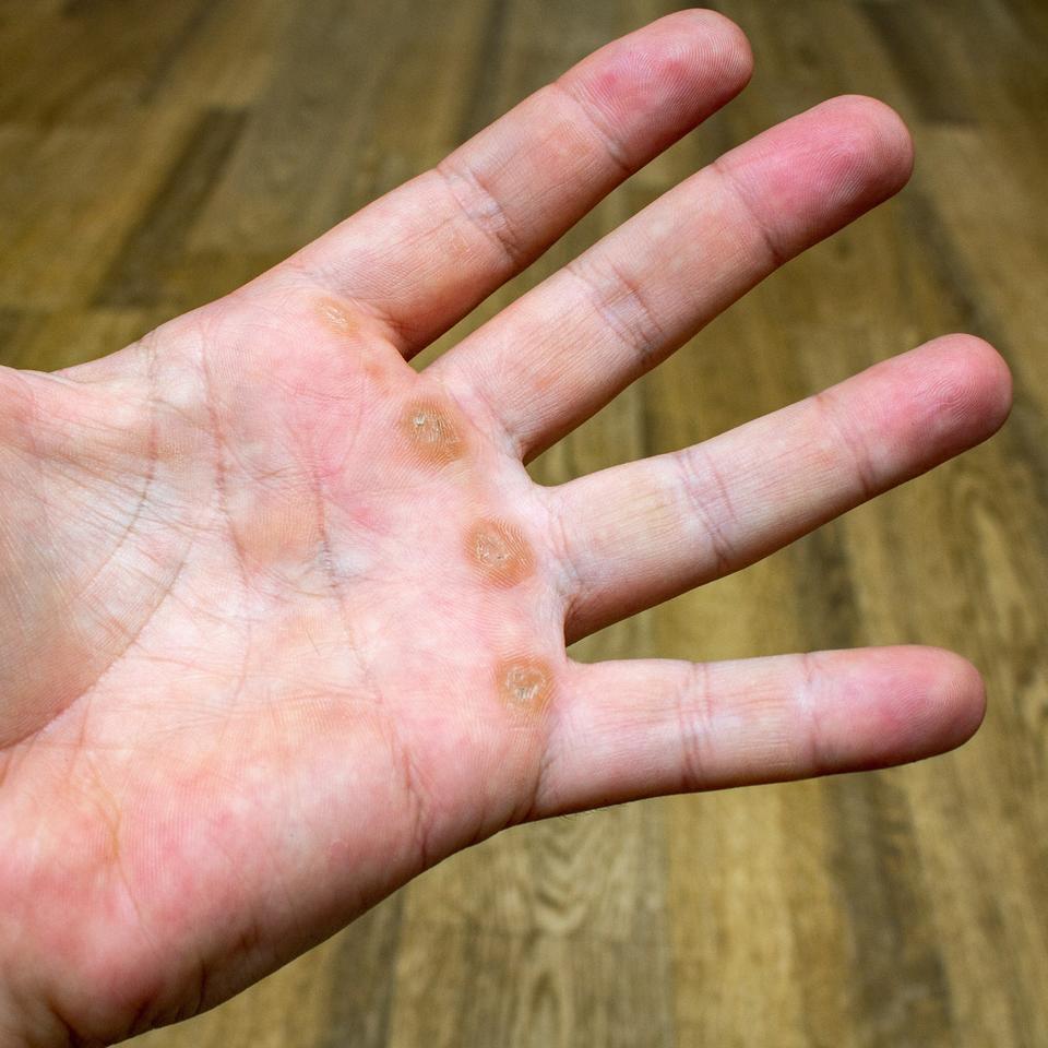 Définition | Induration : qu'est-ce que c'est ? | Futura santé