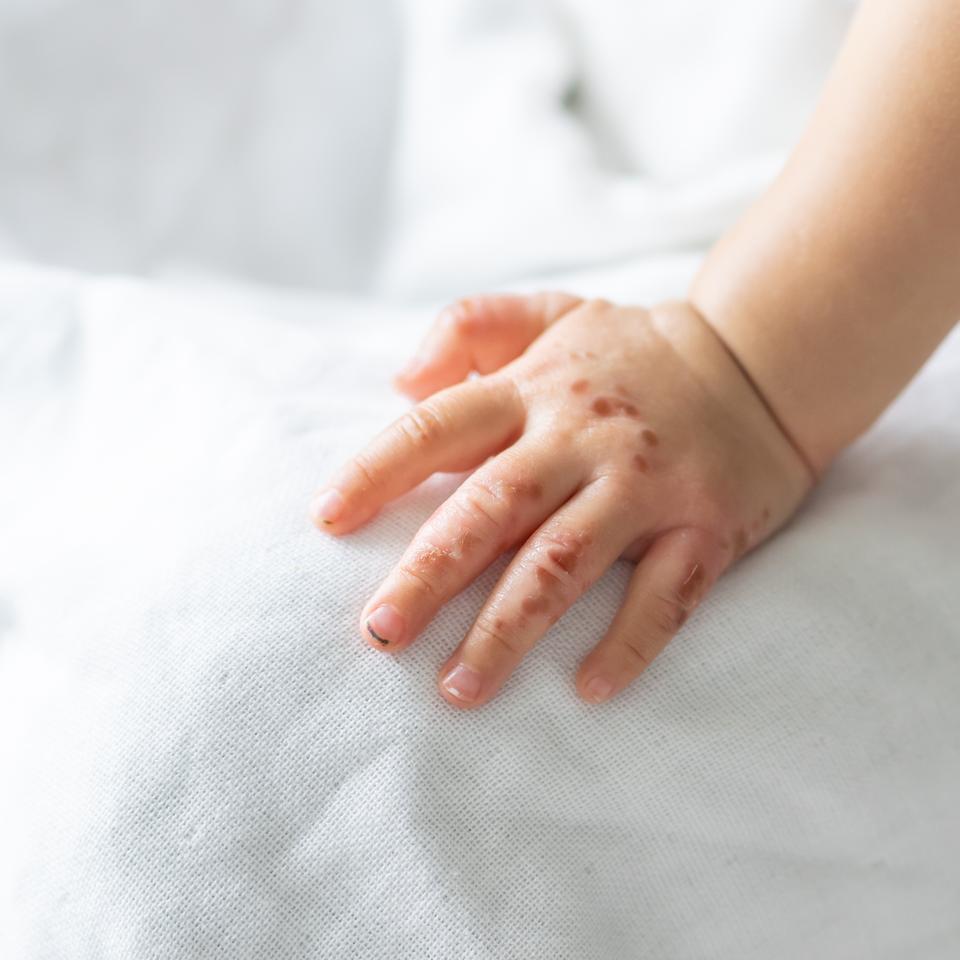 Définition | Épidermolyse bulleuse : qu'est-ce que c'est ? | Futura santé