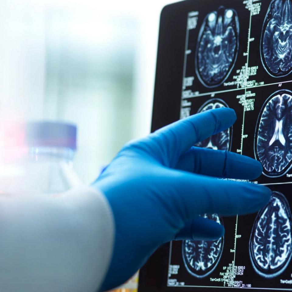Méningite à méningocoque : quand suspecter cette infection grave