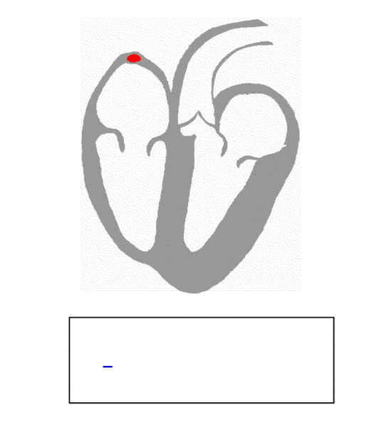 Reprogrammer des cellules cardiaques... en pacemaker biologique